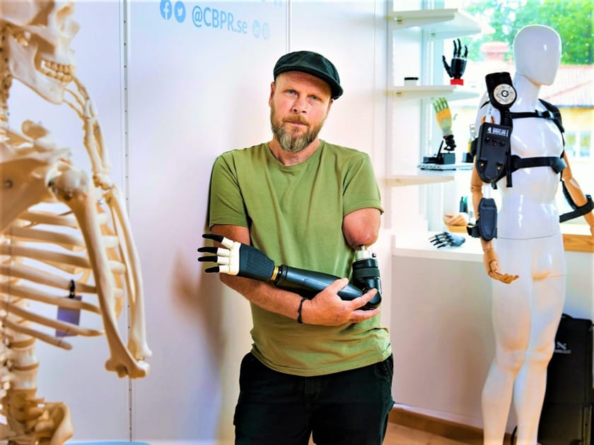 Man Can Move Every Finger on New Bionic Arm | Engoo Daily News